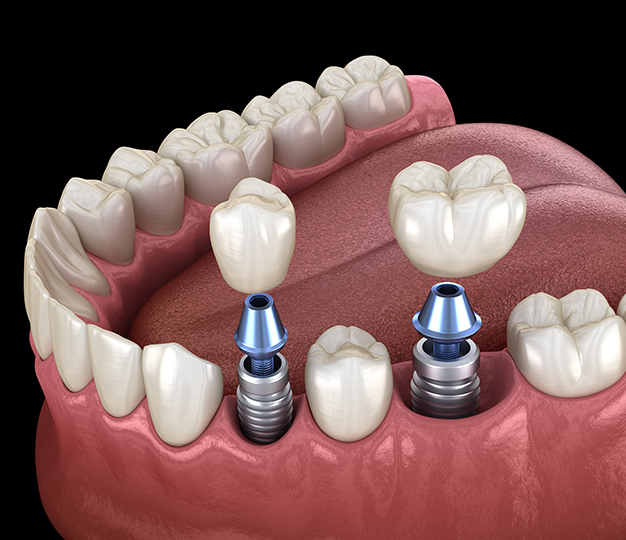 Dental Implants Spring Hill FL | Northcliffe Dental