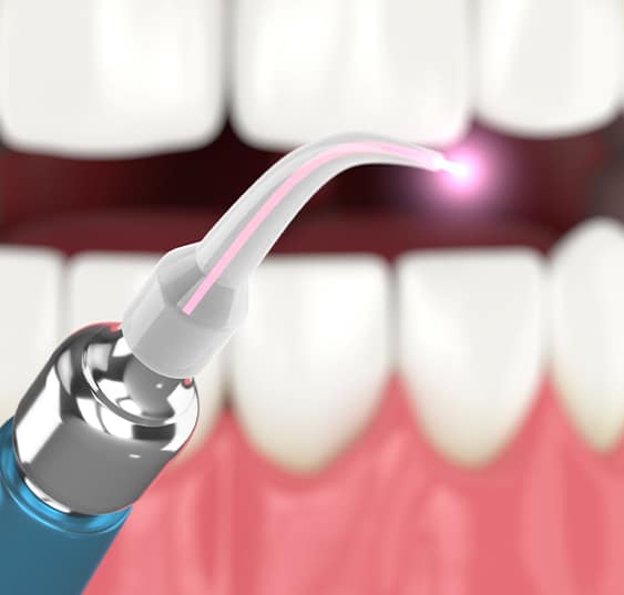 Soft Tissue Laser Treatment Spring Hill FL | Northcliffe Dental