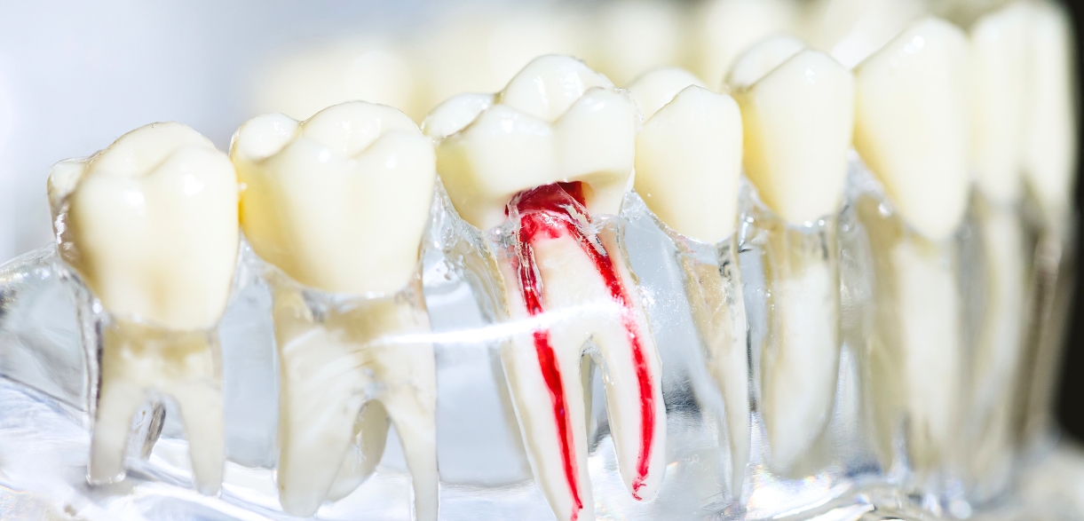 Choosing between root canal and tooth extraction for cracked teeth